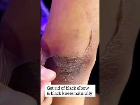Remove DARK Elbow Skin Easily #shorts #youtubeshorts #shortvideo #trending #skincare #viral #makeup