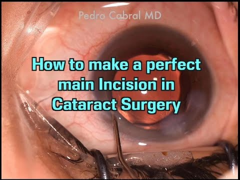 MAIN INCISION FOR CATARACT SURGERY - advanced phacoemulsification by Pedro Cabral MD/