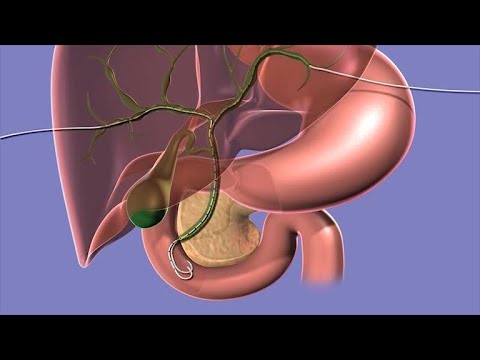 Your Biliary Drain