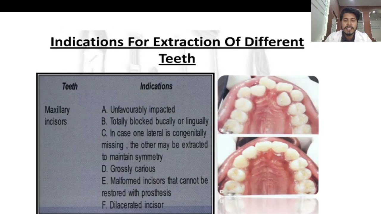 EXTRACTION IN ORTHODONTICS
