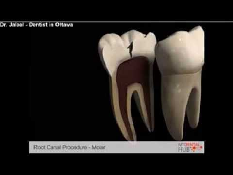 Endodontics - Root Canal Procedure Molar - Dentist Ottawa