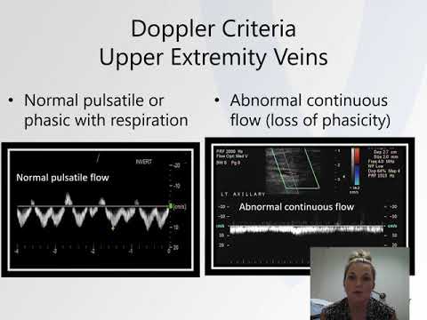 Technical Tip Tuesday Case Study - Upper Extremity Venous Thrombosis