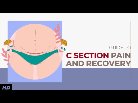 A Guide For C Section Pain And Recovery