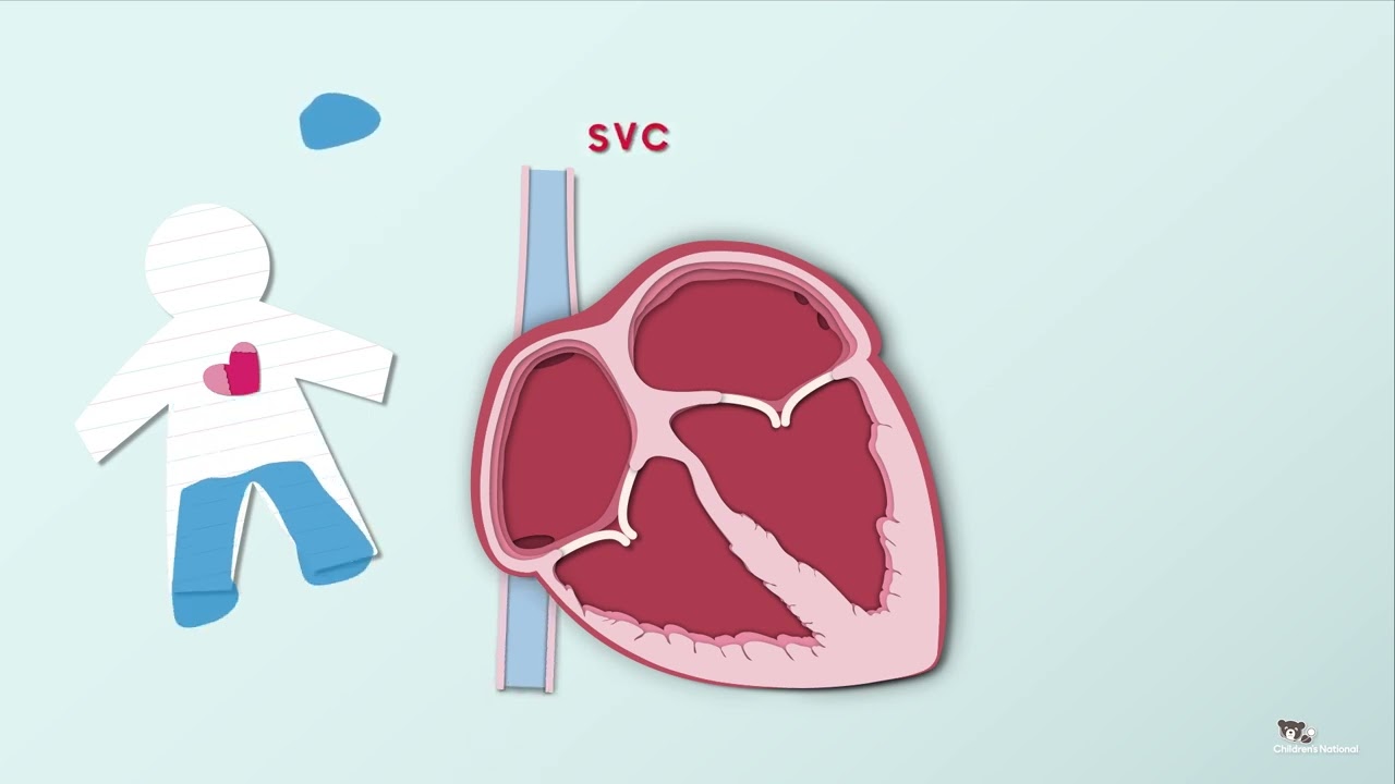 Pediatric Atrial Septal Defect (ASD) - Conditions and Treatments ...