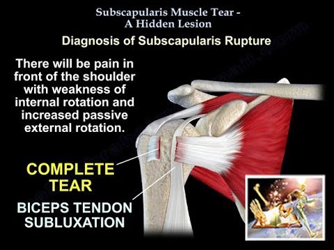 Subscapularis Muscle Tear A Hidden Lesion - Everything You Need To Know - Dr. Nabil Ebraheim