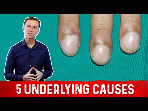 What Causes Clubbing of the Nail?