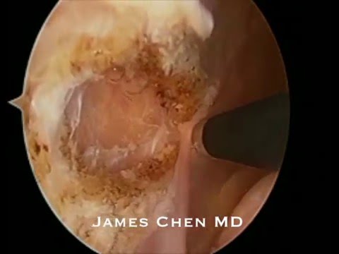 Arthroscopic Lateral Release of the Knee