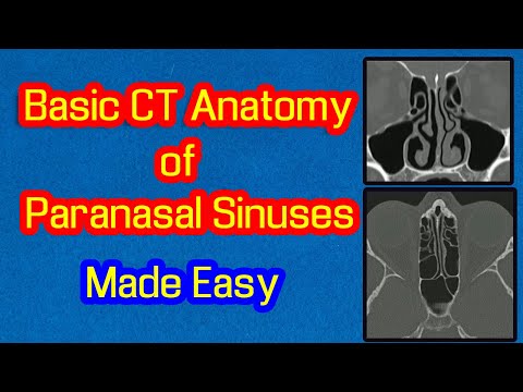 Basic CT Anatomy of Paranasal Sinuses, Made Easy