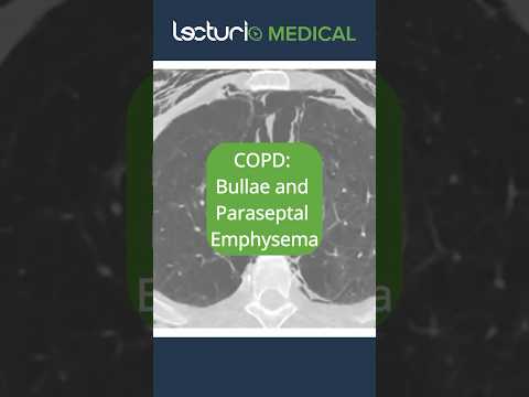 🔍 CT Scan Insights: Bullae & Paraseptal Emphysema! #EmphysemaInsights #RadiologyRevealed #usmle