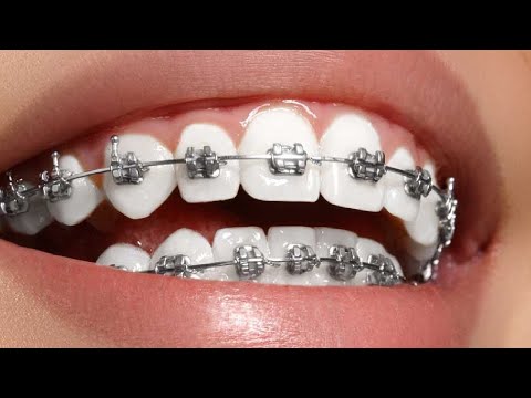 how to look good in pictures with braces