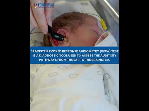 Brainstem Evoked Response Audiometry (BERA) Test | Auditory Brainstem Response (ABR) | Echo Hearing