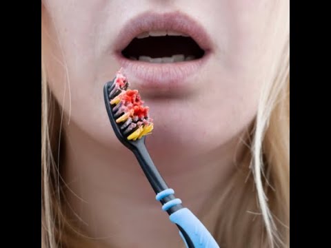 Gum Disease treatment at Audley Dental
