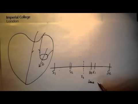 Gallop rhythm