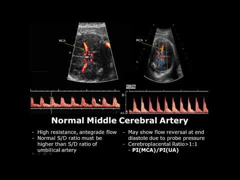 Fetal Middle Cerebral Artery Doppler Ultrasound Normal Vs Abnormal Image Appearances | MCA USG