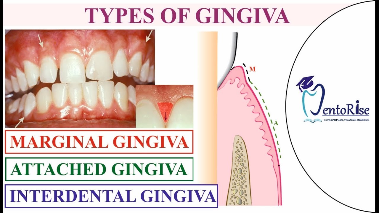 Gingiva anatomy | Gingiva types | Carranza | Marginal Attached & Interdental Gingiva Periodontology