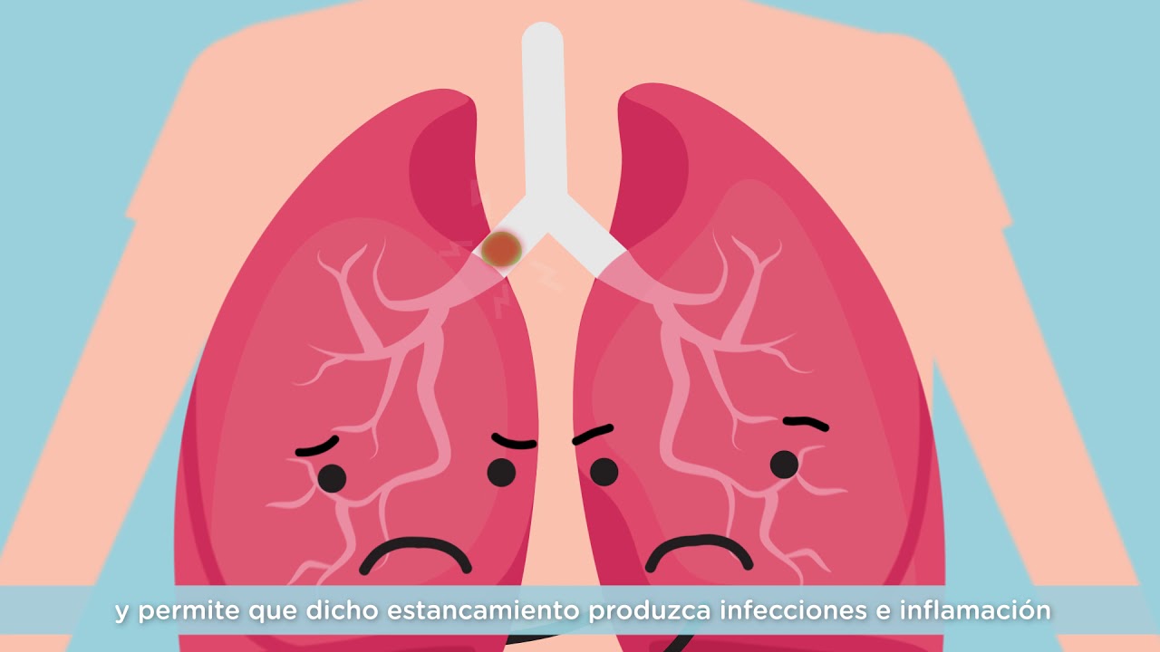 Vídeo 1 - ¿Qué es la Fibrosis Quística?