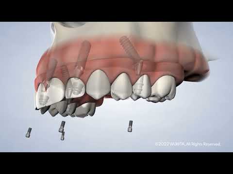 Full Arch with Dr. Koshgerian at The Oral Surgery & Dental Implant Specialists of San Diego