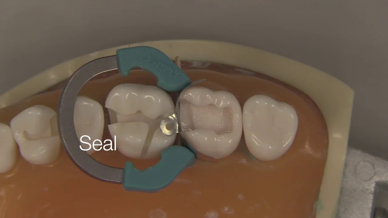 Class II Composite Restoration | Stevenson Dental Solutions
