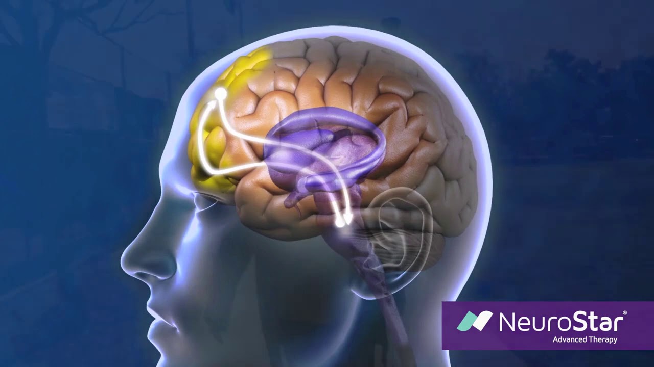 How NeuroStar Works Refresh TMS