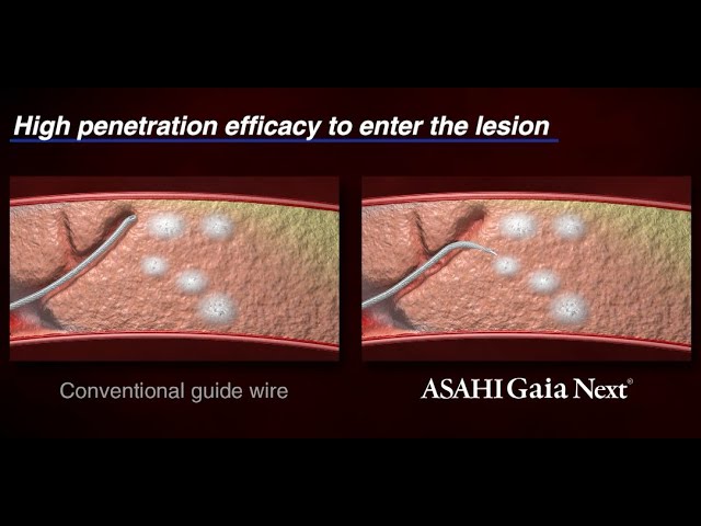 Asahi - Asahi Rinato Guide Wire Trader - Wholesaler / Distributor from ...