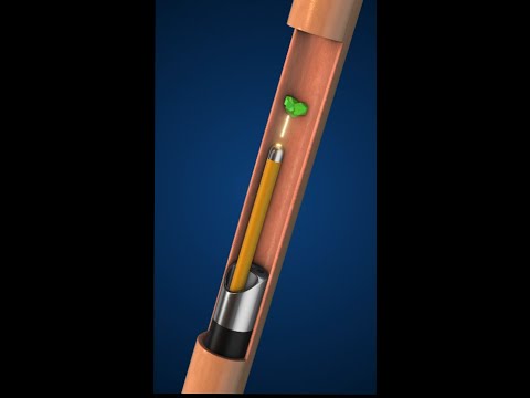 Kidney Stones Demolished: Laser Lithotripsy #shorts #science #health