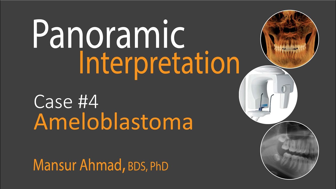 Ameloblastoma: Panoramic Radiographic Interpretation