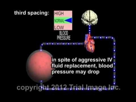 Third Spacing Fluid Response to Surgical Stress video - Animation by Cal Shipley, M.D.