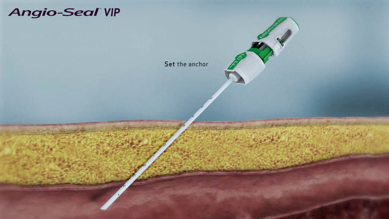 angioseal video