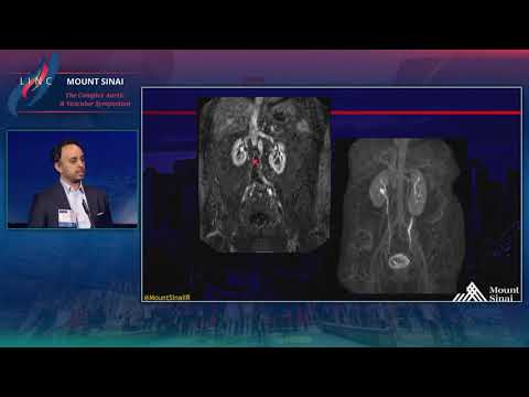 Immediate and Long-Term Complications Of Inferior Vena Cava Filter Placement