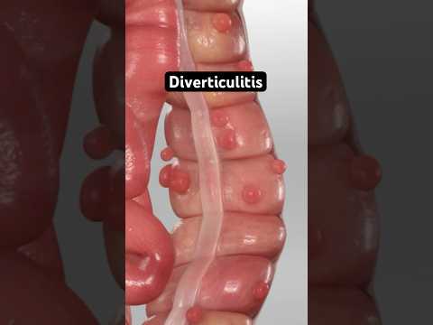 Diverticulitis (3D Animation)