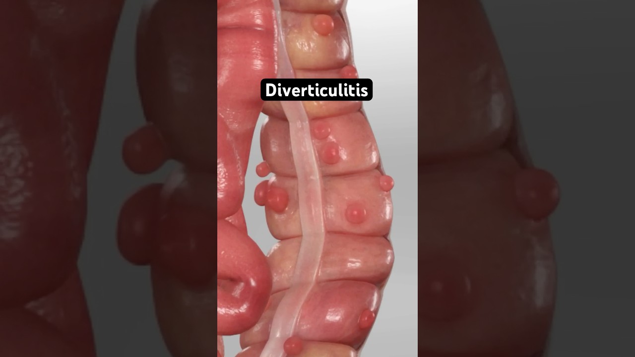 Diverticulitis (3D Animation)
