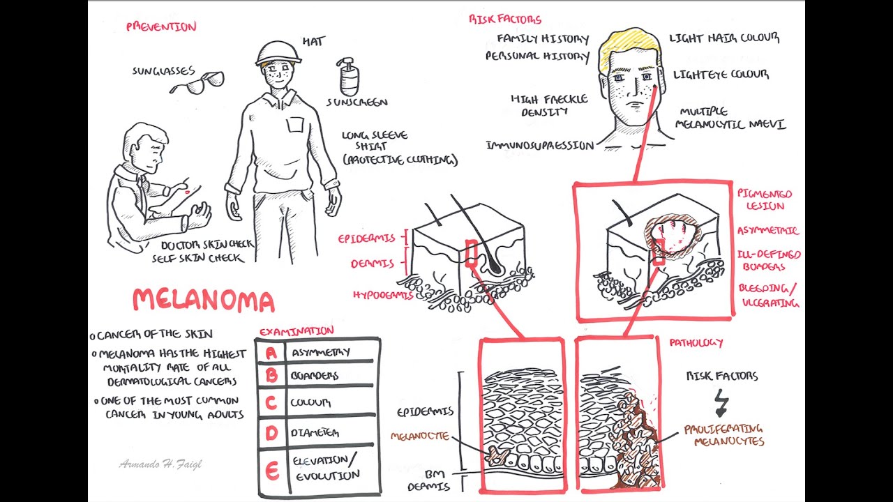 Melanoma - Overview (signs and symptoms, pathology, risk factors, treatment)