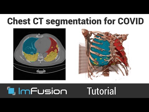 ImFusion Labels - How to segment 3D Chest CT for COVID