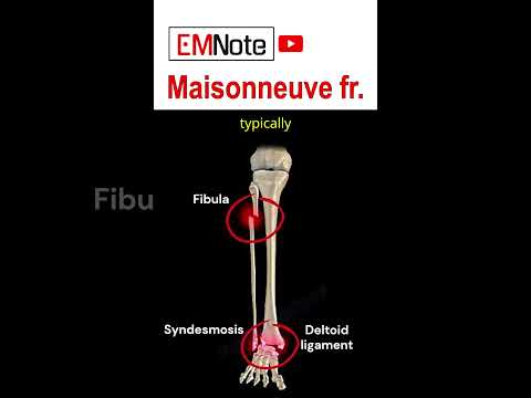 Maisonneuve Fracture