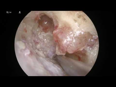 4K Transcanal Endoscopic Extended Transpromontorial Removal of a Vestibular Schwannoma