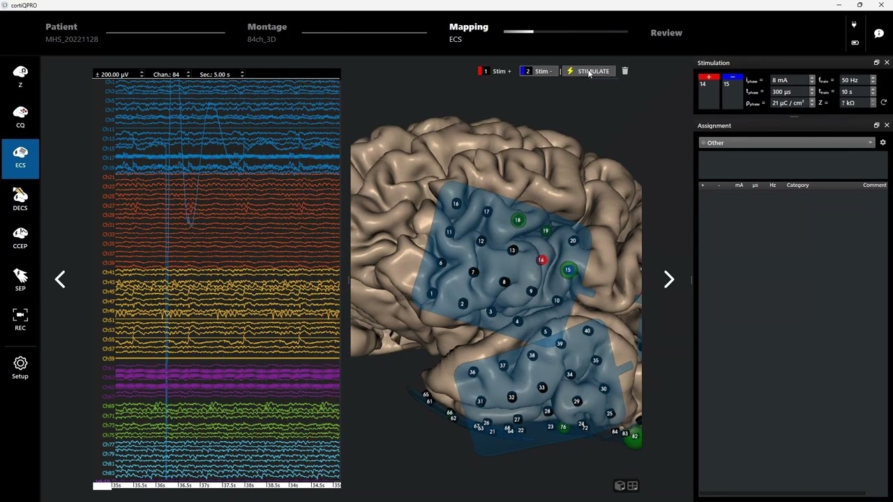 cortiQ Rapid Cortical Mapping | g.tec medical engineering cortiQ Rapid Cortical Mapping | g.tec medical engineering