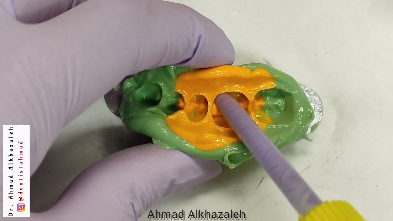 🎇 indirect class II restoration using resin composite! ✅ anatomy and contours on point!! ✅