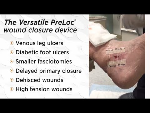 ZIP AND PRELOC OVERVIEW FOR FOOT ANKLE MA10740A