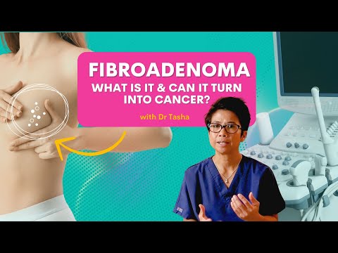 Understanding Fibroadenomas: Can it turn to cancer? - with Dr Tasha