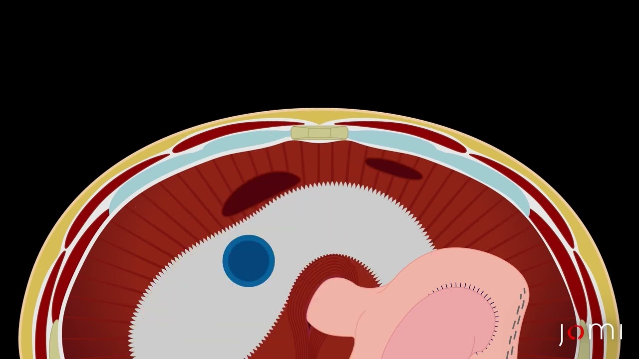 Exploratory Laparotomy for Bowel Obstruction with Primary Repair of Two Diaphragmatic Hernias