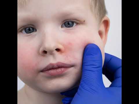 Pediatric Eczema and Scratch Sensors with Steve Xu, MD, MSc