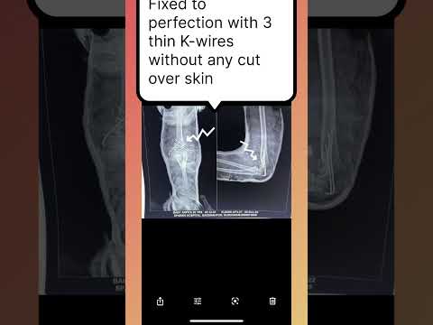 Displaced supra-condylar fracture humerus in kid fixed without any cut over skin. #dr_ankit_bhartia