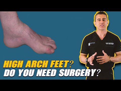 High Arch Feet? Do you need surgery? | YouTube Shorts