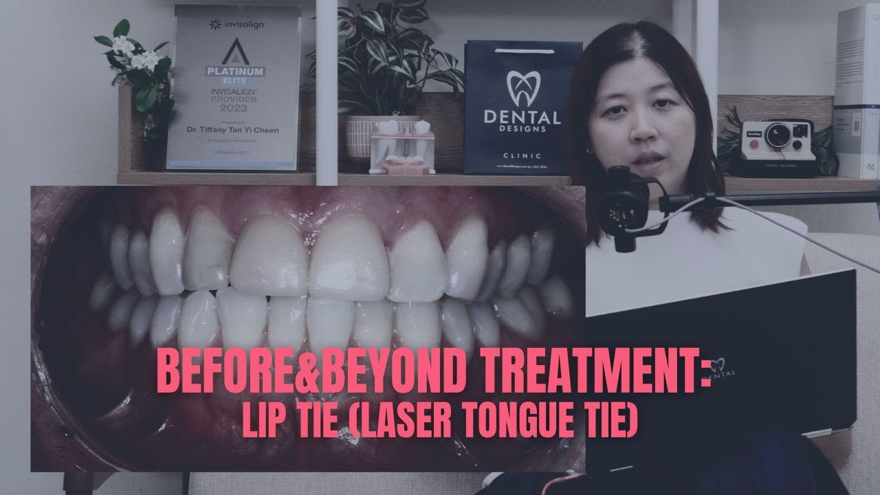 Do You Have a Lip Tie? Symptoms, Risks & Laser Treatment Explained | BEFORE & BEYOND EP24