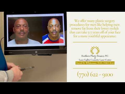 Plastic Surgery for Men: Fat Removal of the Lower Eyelids