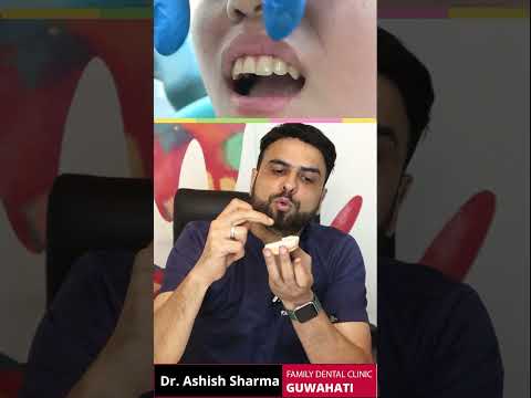 How Much Do Dentists Shave Teeth for Veneers? #shortsfeed #guwahati #assam #smile