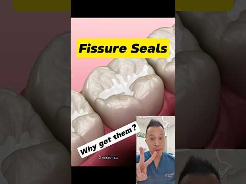 Seal Out Decay: The Benefits of Fissure Sealants #shorts #dentallan #dentist