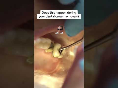 Does this Happen When You Remove Dental Crowns?