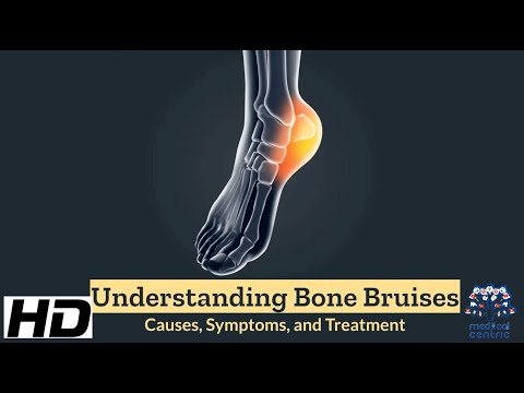 When Bones Get Battered: Exploring Bone Bruises and Their Remedies