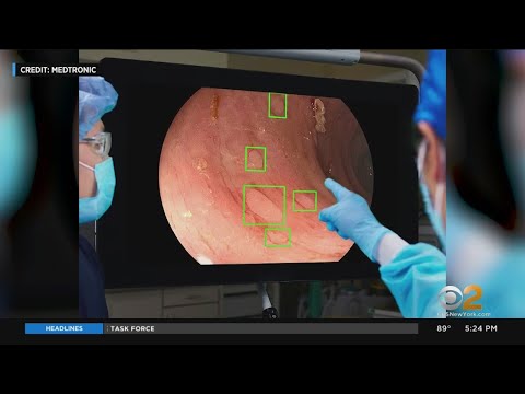 New AI helps detect potentially cancerous polyps in the colon